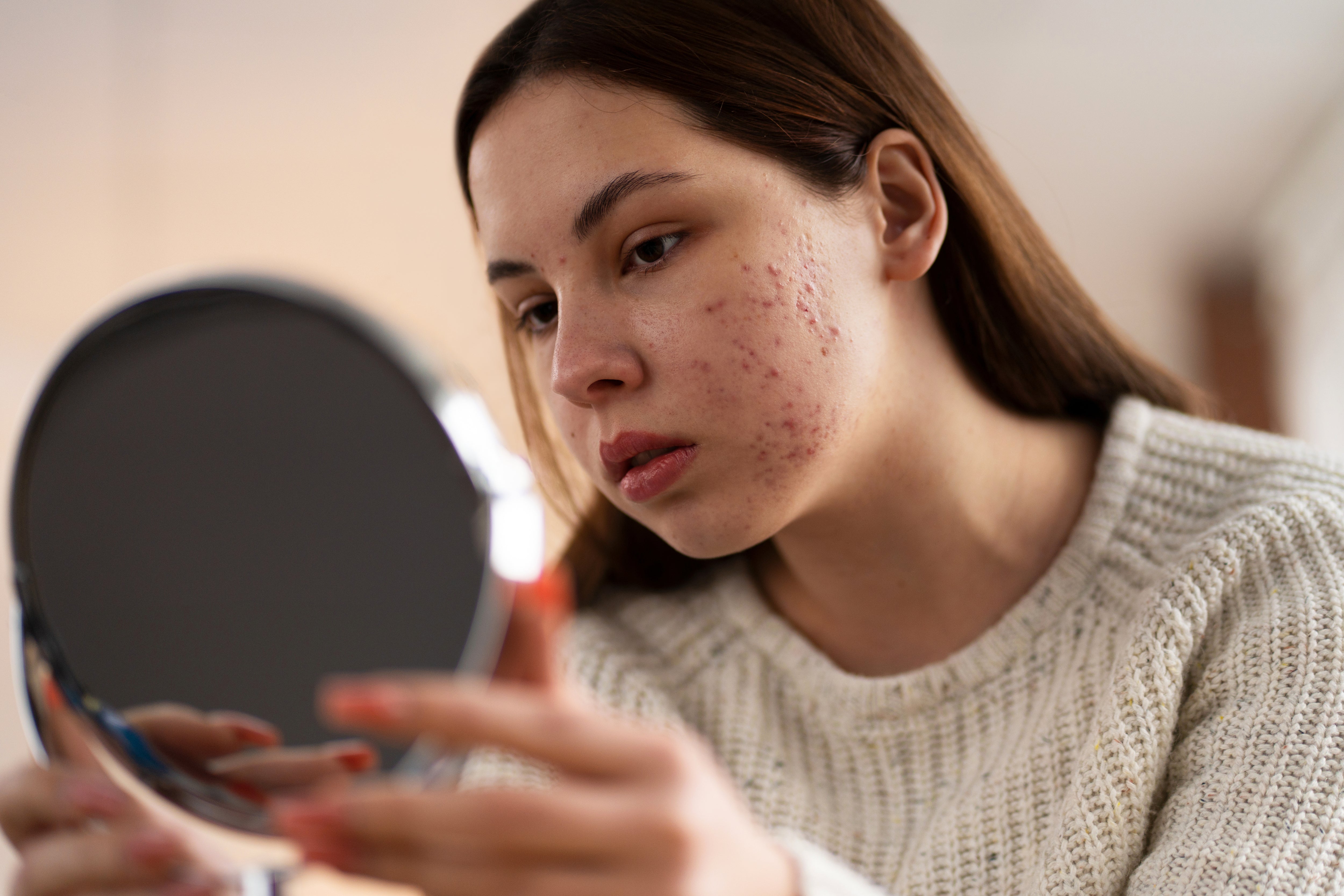 The Ultimate Guide to Fading Acne Scars Naturally – Lusso Alchemy
